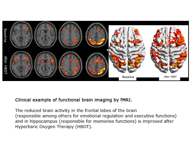 Clinical example of functional brain imaging by fMRI.